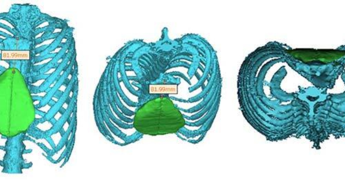 3D-Printed Model of Implant for Pectus Excavatum - ÉTS Montréal